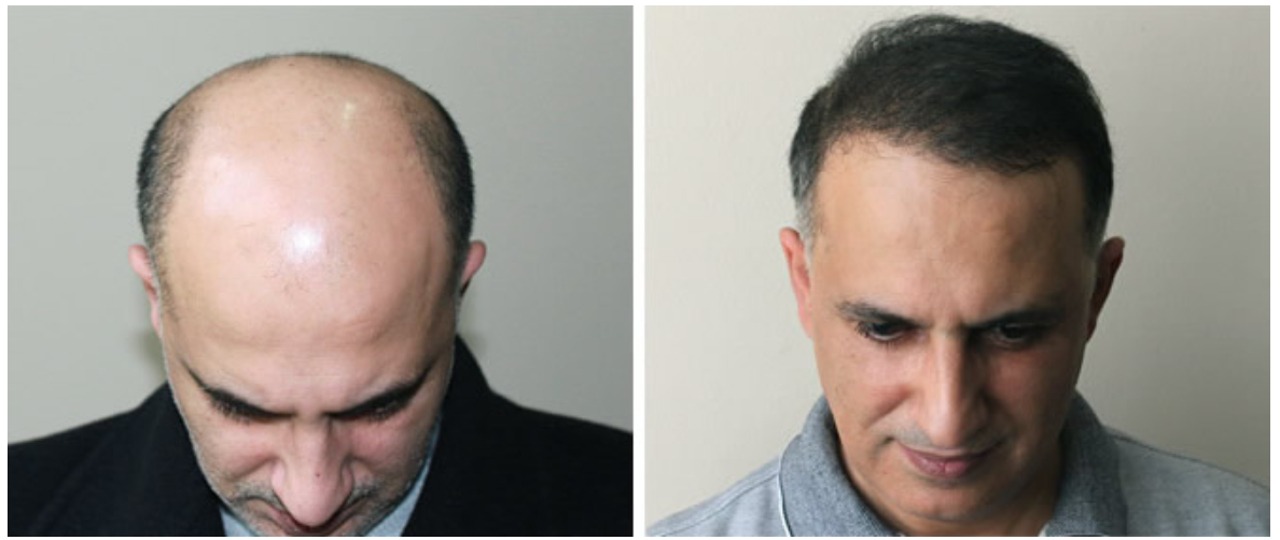 Greffe de cheveux : quelle est la meilleure technique ? - GREPHH